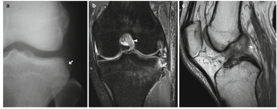 Segond骨折与Gerdy结节撕脱性骨折磁共振要点 - 知乎