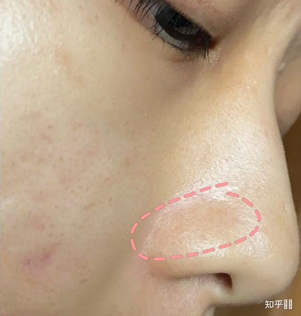 我该拿这个巨大的黑头怎么办?求经验 知乎
