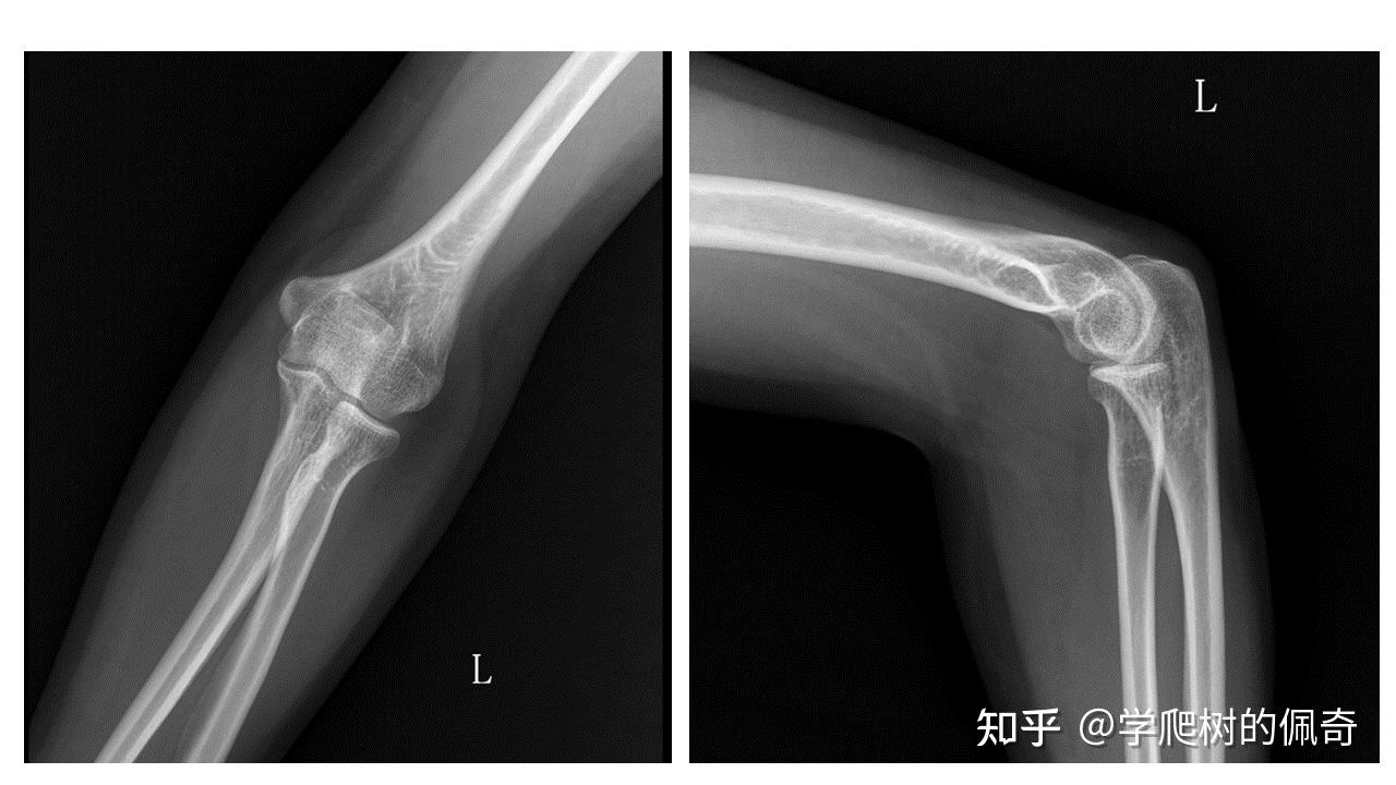 NHANES数据库练手DAY12(酒与骨的研究) - 知乎