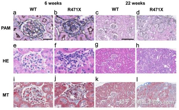 Alport综合症致病基因之COL4A5 - 知乎