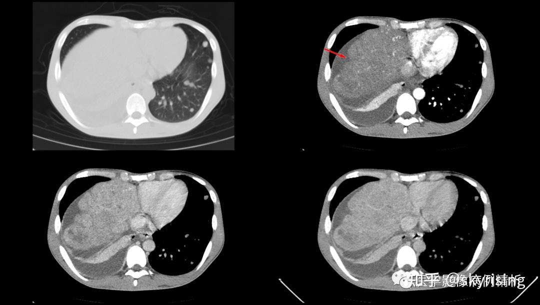 浅谈CT增强技术对影像图片显示质量影响及解决方法并肝脏恶性肿瘤、多发转移报告范例（全文） - 知乎