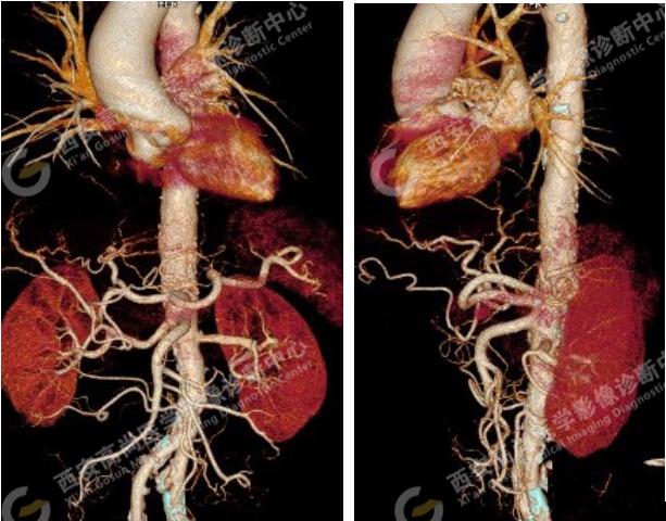 PET/CT-CTA多模态诊断穿透性动脉粥样硬化性溃疡（PAU）一例 - 知乎
