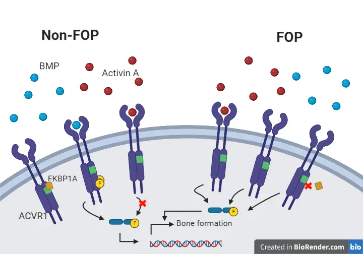 进行性骨化性纤维发育不良（FOP） - 知乎