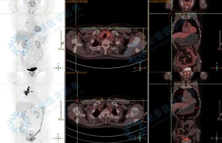 警惕！肺癌早期就能发生转移！CT、PET/CT到底在什么情况下做？ - 知乎