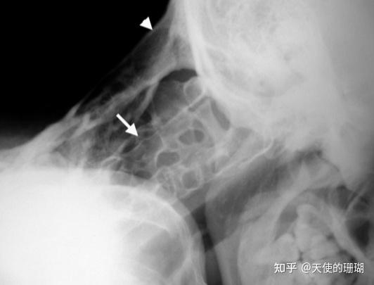 FOP患者的颈椎发育异常明显不同于Klippel-Feil综合征患者 - 知乎