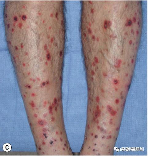 易跟过敏性紫癜混淆的疾病有哪些？（完结篇） - 知乎