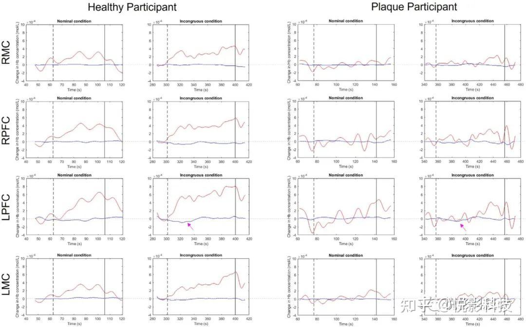 老年人Stroop任务期间颈动脉粥样硬化与脑激活模式的联系：fNIRS研究 - 知乎