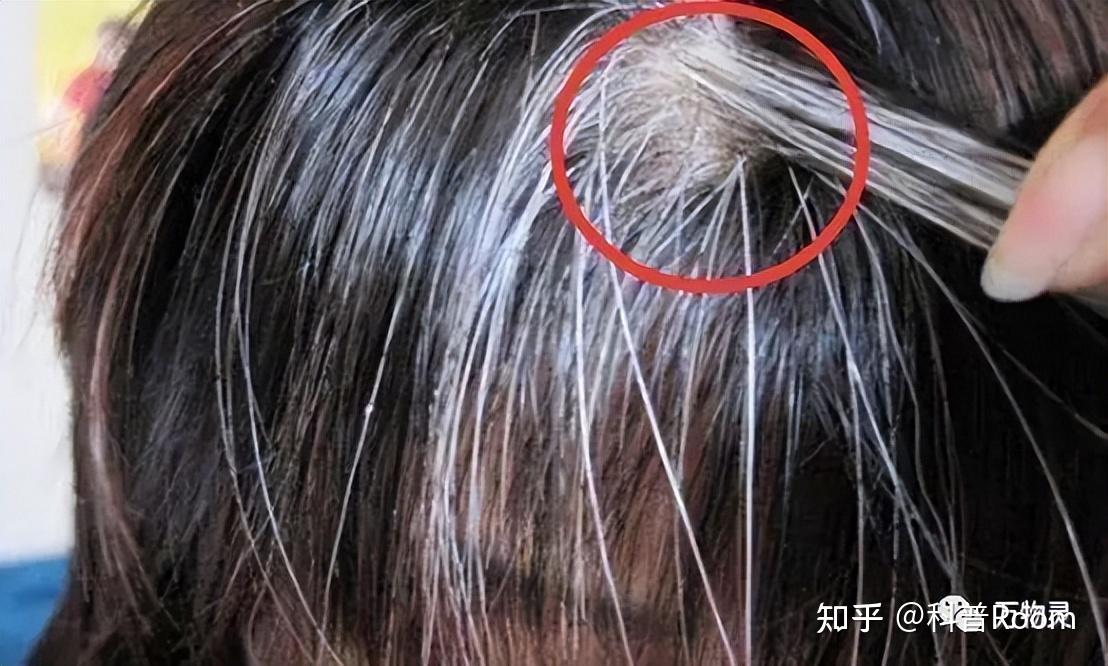 白发越拔越多,这是真的?白发变黑有望,研究已发现逆转 开关 知乎