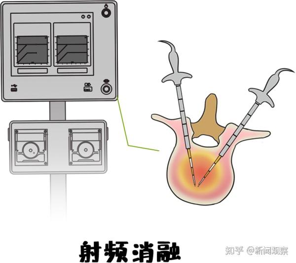 抗癌先“治痛”，OsteoCool™射频消融创新技术给骨转移瘤患者带来“新希望” - 知乎