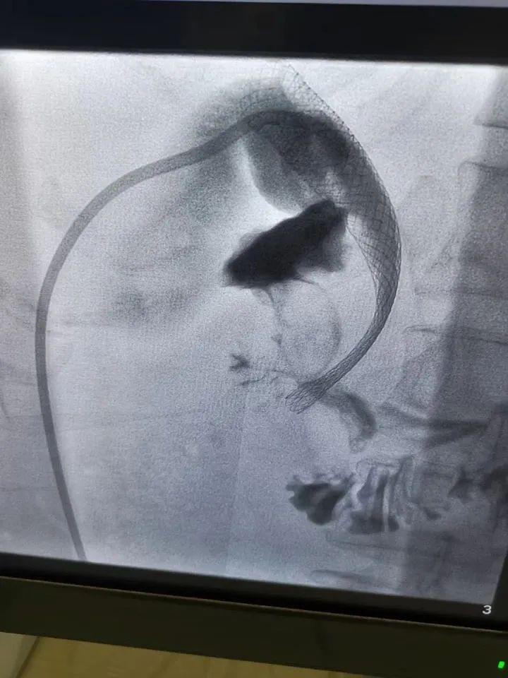 病例分享-经PTCD通道放置胆道支架解除梗阻性黄疸 - 知乎