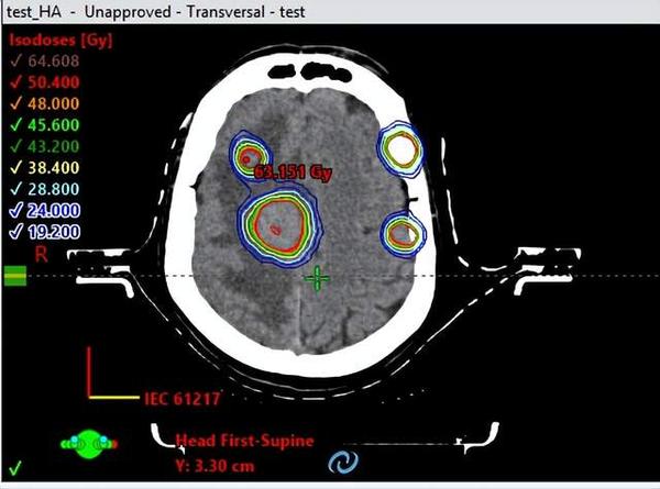 100万脑转移瘤救星【HyperArc超弧刀】——无创治疗颅内肿瘤 - 知乎
