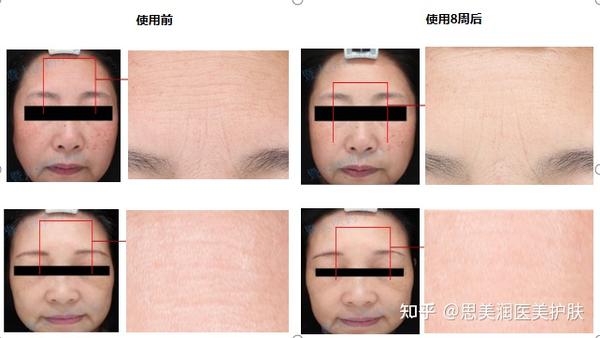 成年人为什么一定要补充III型胶原蛋白？ - 知乎