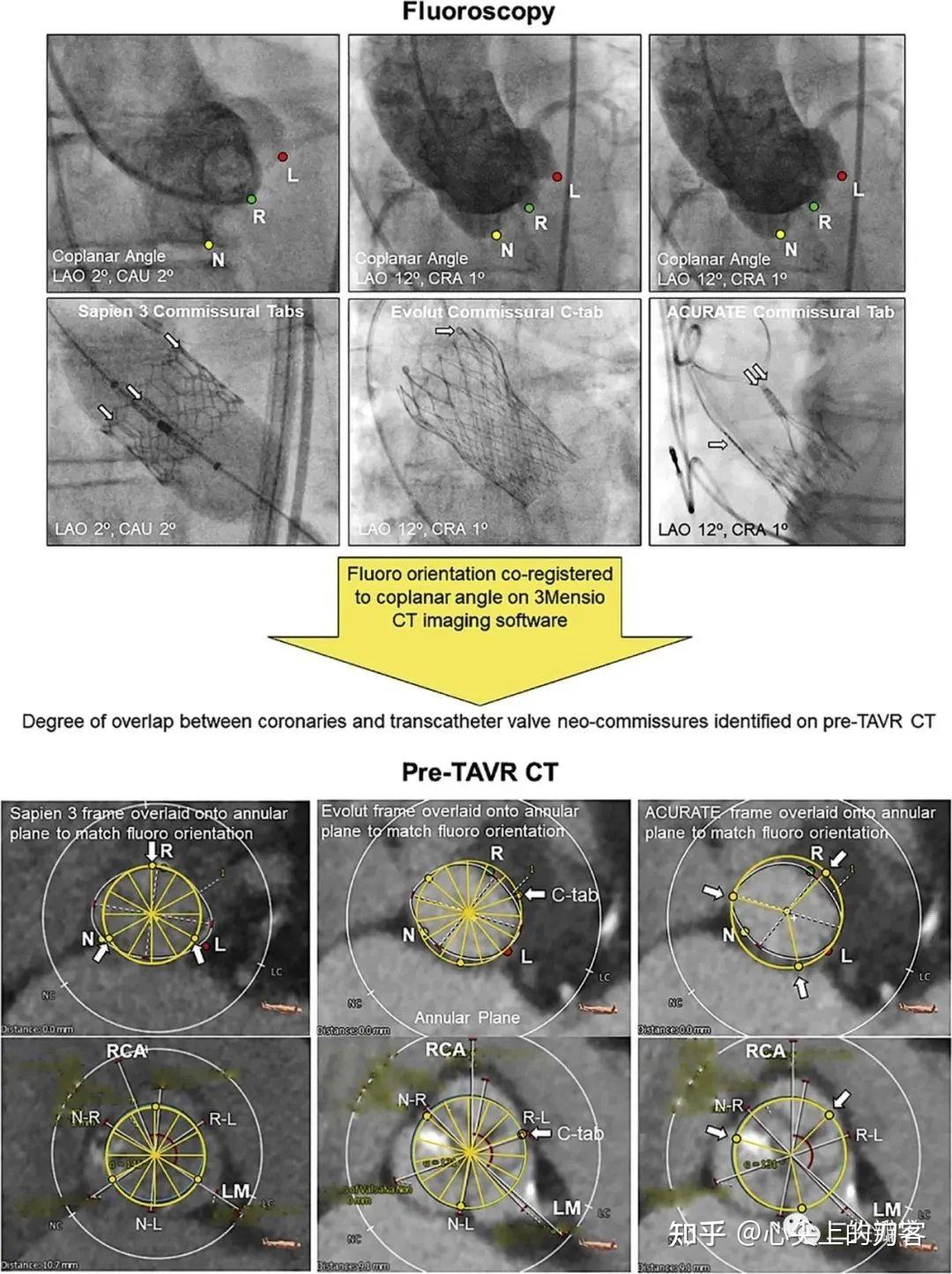 连合对齐（Commissural Alignment）：原理、定义、技术和结果（中） - 知乎