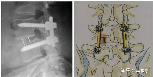 UBE 这些差别你知道吗？PLF PLIF TLIF DLIF XLIF 手术技术对比【医术苑】科普 - 知乎