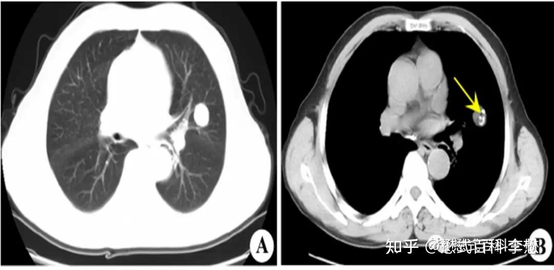 在医学影像学中，CT 扫描是如何工作的？ - 知乎