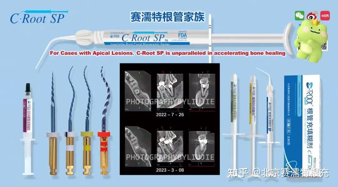 赛濡特锶生物陶瓷C-Root SP：让根管充填如此简单！青岛口腔展！ - 知乎