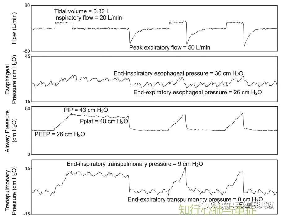 第149期 滴定PEEP的9个方法 - 知乎