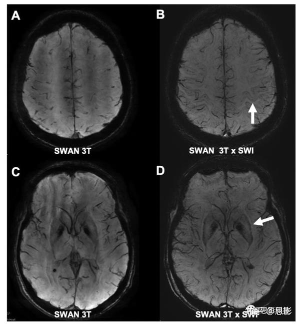磁敏感加权成像（SWI)：技术要点和临床神经学应用 - 知乎