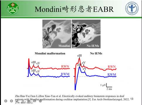 临床听力学技术专业沙龙｜人工耳蜗植入术中及术后EABR的应用 - 知乎