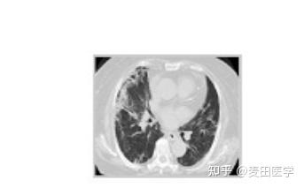 文献速递：人工智能医学影像分割--- 使用带有主动轮廓和CNN分类器的FCM对CT肺部图像进行分割 - 知乎