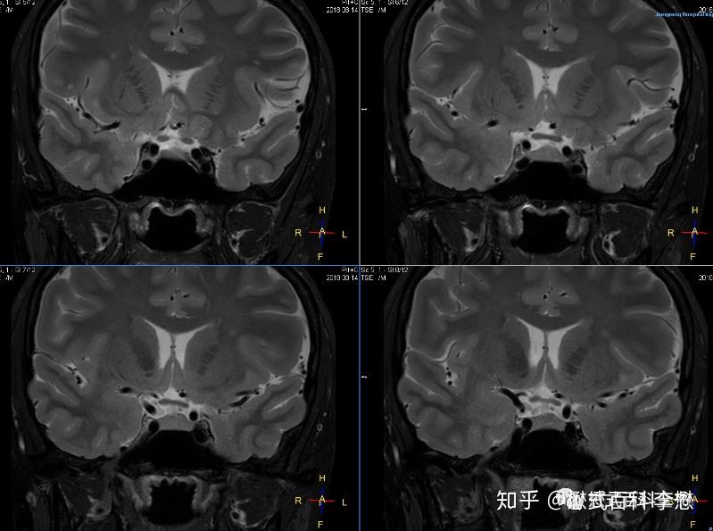 磁共振垂体扫描Pituitary MR Imaging（一） - 知乎