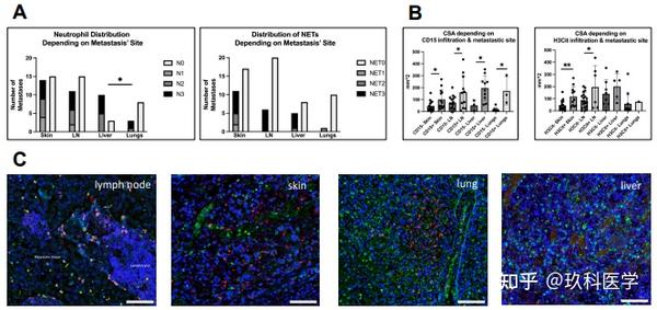 NETs/NETosis | 中性粒细胞的另一重身份：与肿瘤共谋、暗中助长 - 知乎