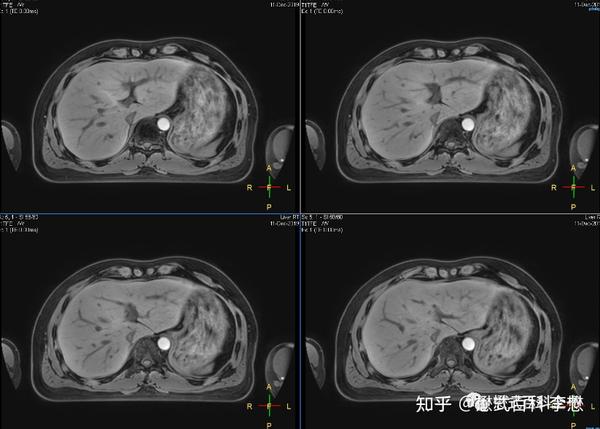 MRI星芒状伪影 - 知乎