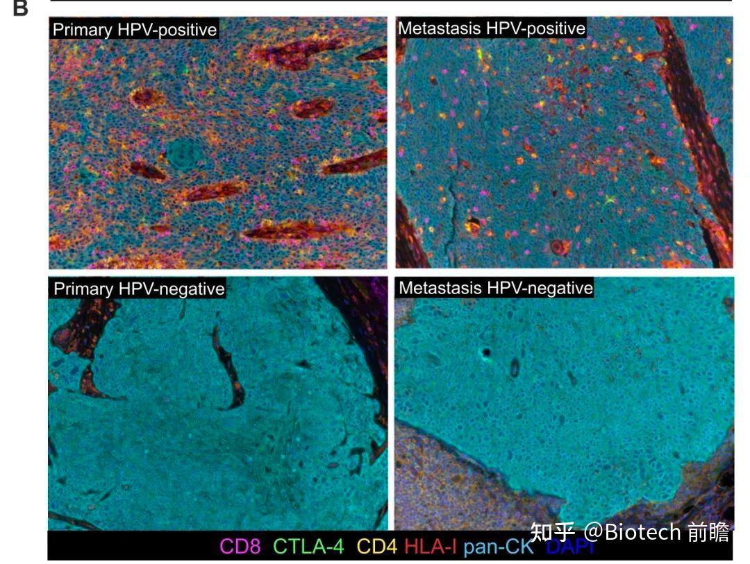 HPV感染型肿瘤免疫获益的机制研究，可摒弃PD-L1筛选？ - 知乎