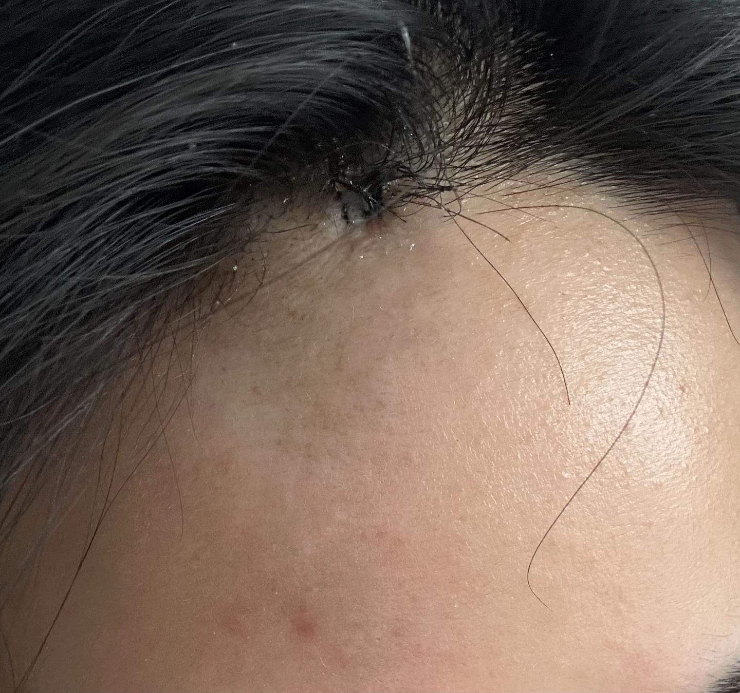 局限性硬皮病治疗过程 知乎