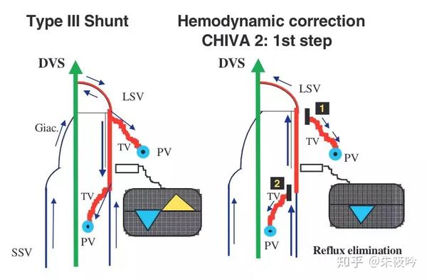 CHIVA治疗下肢静脉曲张：优势与结果 - 知乎