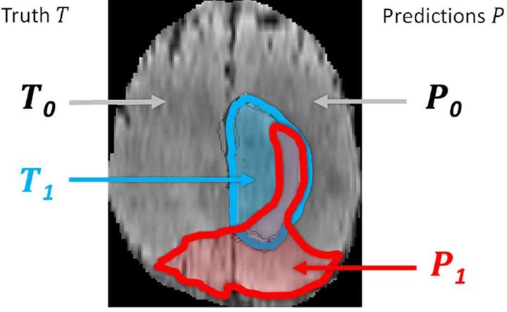 Dice 与Dice Loss介绍及MindSpore的实现代码 - 知乎