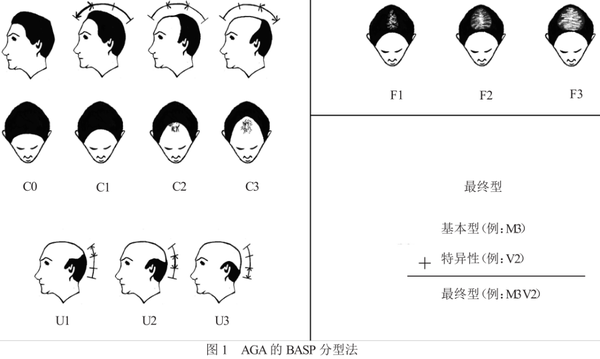 “颜值杀手”--雄激素性脱发 - 知乎
