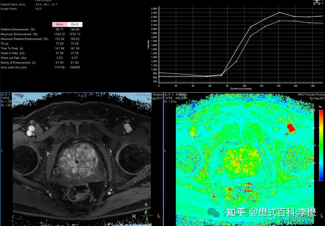 磁共振动态扫描 MRI Dynamic Scan