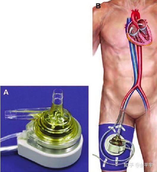 pVAD：心室辅助装置Impella路线的全球领先地位及中国发展前景 - 知乎
