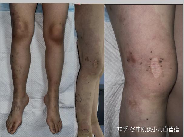 KT综合征(Klippel-Trenaunay syndrome，KTS) 介入治疗 - 知乎