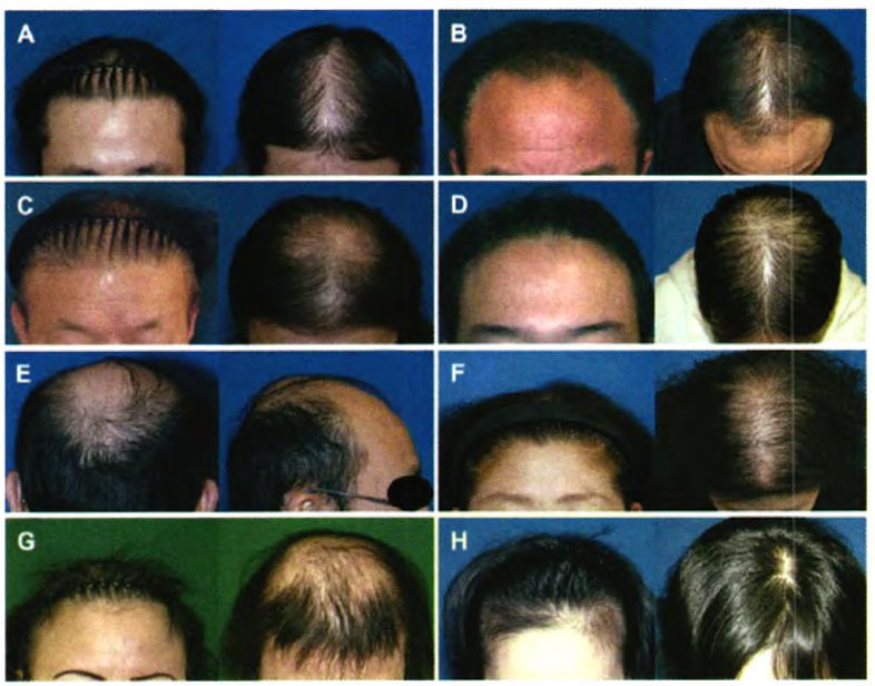 “颜值杀手”--雄激素性脱发 - 知乎