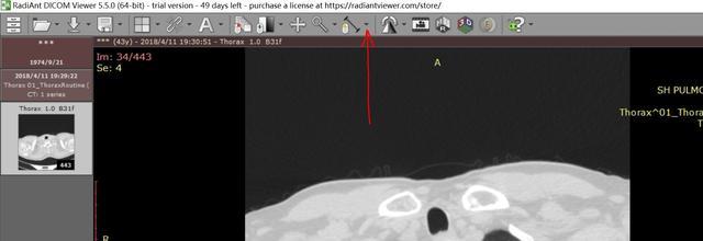 分享一个可以打开医院拷贝的原始格式(DICOM)影像资料的免费软件 - 知乎