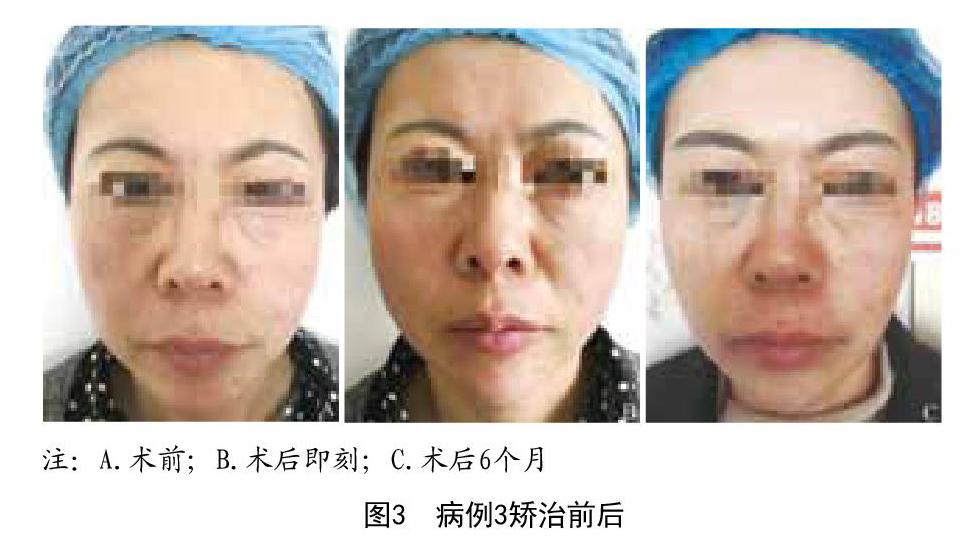 知乎盐选 | PPDO 双向锯齿线皮下埋置面部提升术的临床应用