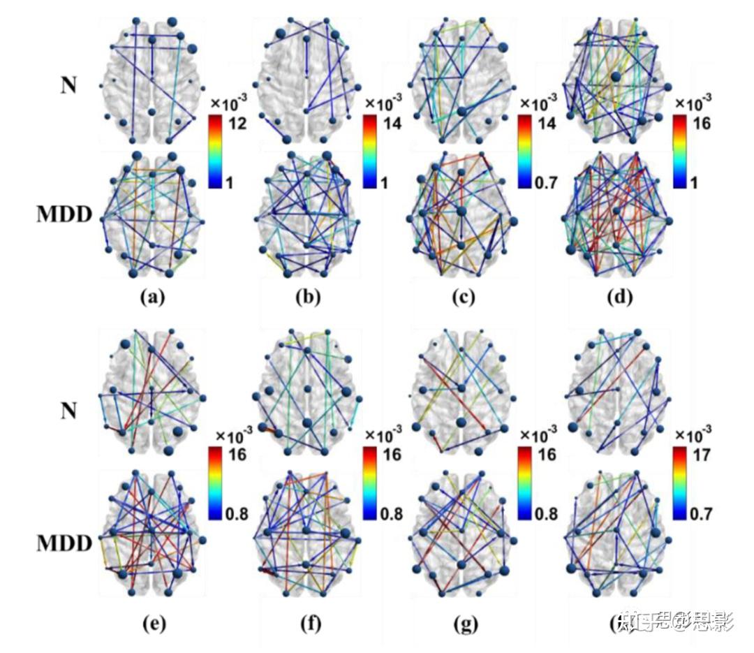 基于脑电信号的重度抑郁症定向功能性脑网络图论分析 - 知乎