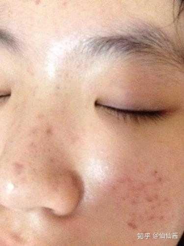 脸上有红色、褐色痘印怎么办？如何有效淡化脸上的痘印？ 知乎