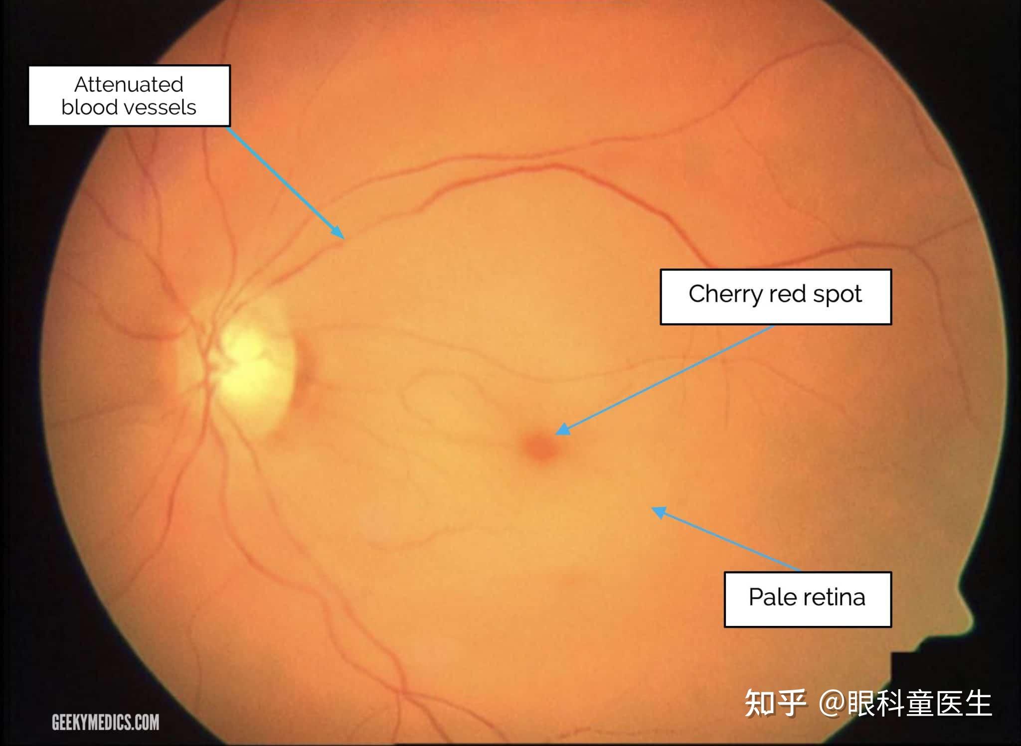 眼底彩照和眼底造影阅片 - 知乎