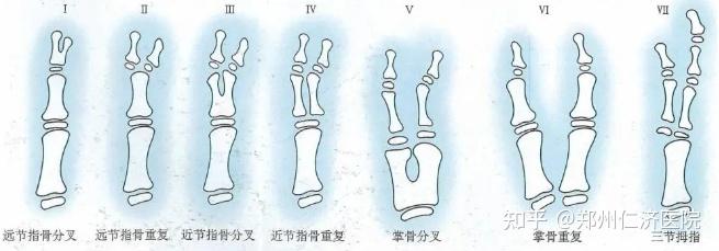 1岁宝宝双手双足多指、趾畸形 - 知乎