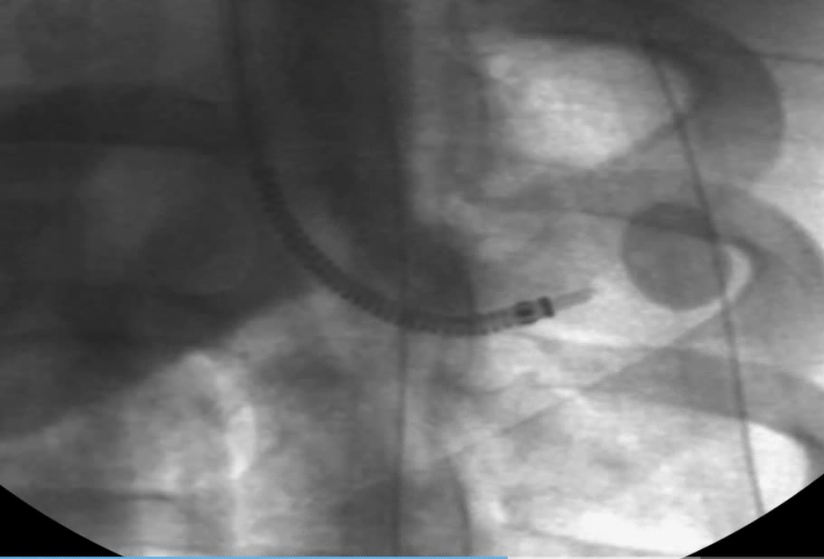 intuitive surgical的新产品Ion™ endoluminal system - 知乎