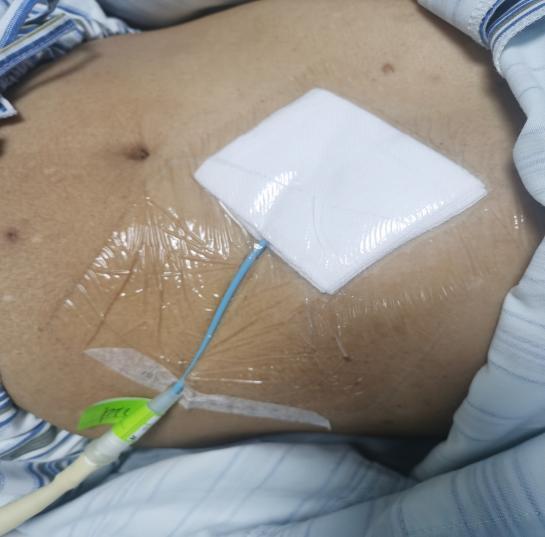 ptcd管脱落，什么情况下才能进行再次穿刺呢？ - 知乎