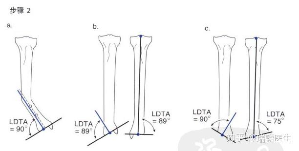 《矫形外科原则》读书笔记（二）-胫骨机械轴及解剖轴分析 - 知乎