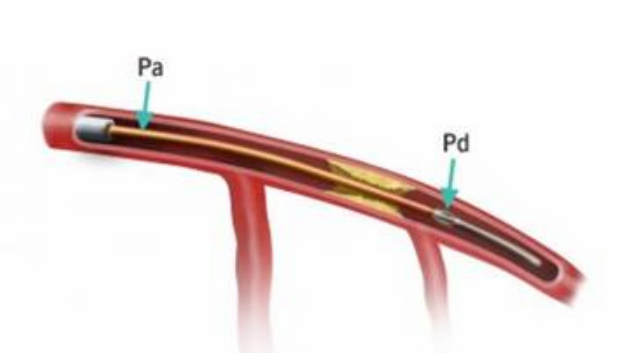 关于冠脉血流储备分数FFR、QFR、FFRCT的简单笔记 - 知乎