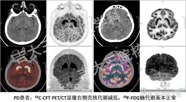 核医学科：精准诊断帕金森病不再困难 - 知乎