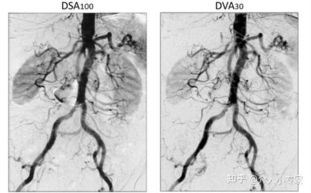 新血管造影技术DVA获FDA批准和CE认证 - 知乎