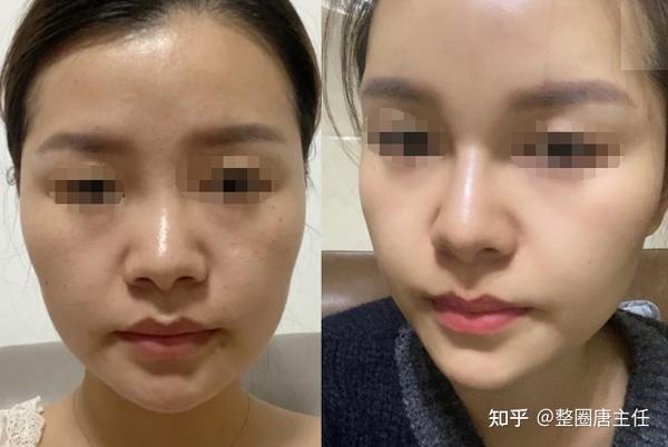 最近很火的少女针是什么？到底值不值得打？安全吗?一篇文章帮你避坑 - 知乎