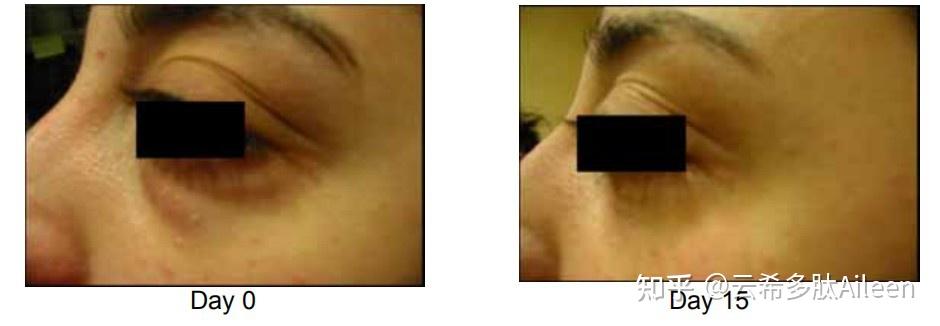 眼丽肽Eyeliss（二肽-2+棕榈酰四肽-7）为何用于祛眼袋黑眼圈 - 知乎